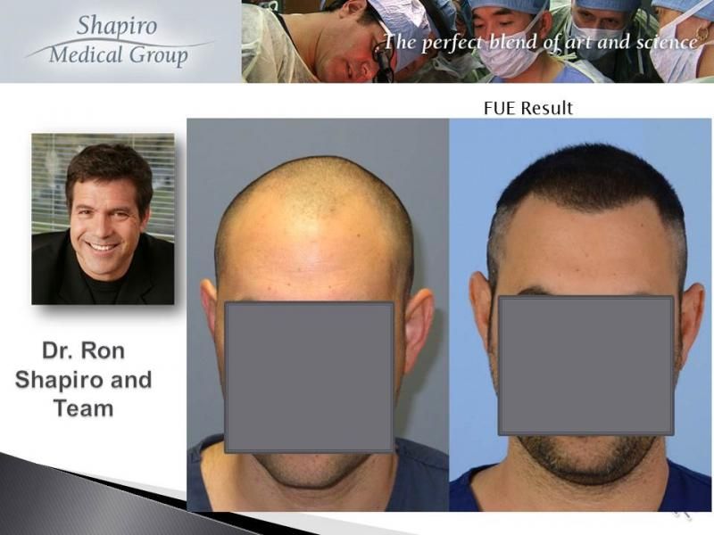 CASO DR.RON SHAPIRO 3590 GRAFTS FUE Bellicapelli Forum