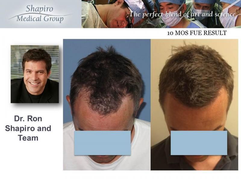 CASO DR.RON SHAPIRO 1862 GRAFTS FUE Bellicapelli Forum